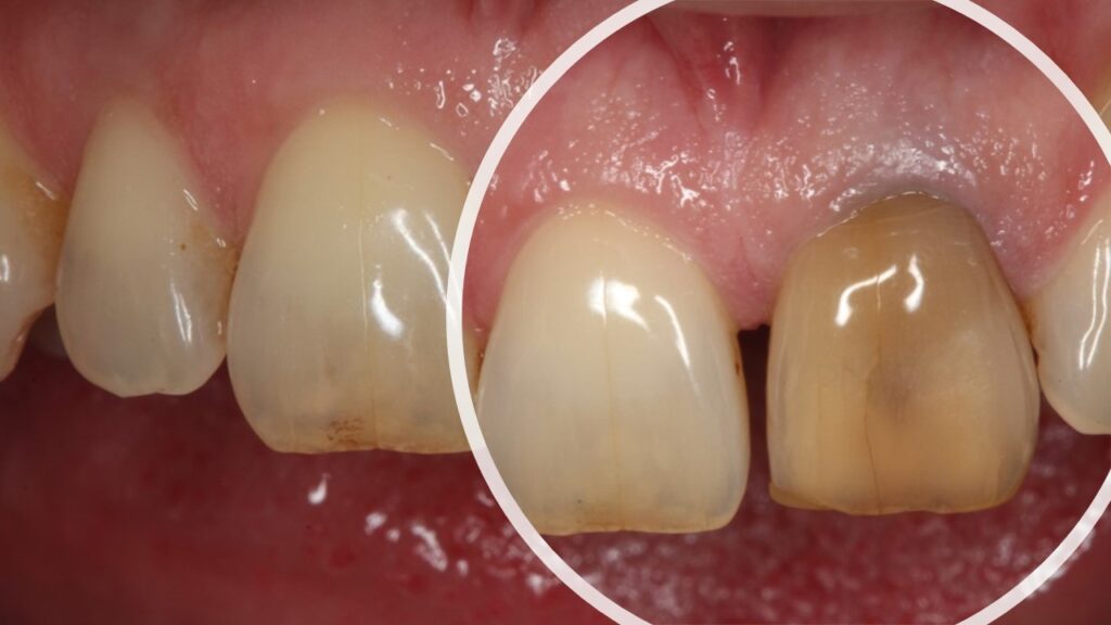 internes Bleaching - Zahnarztpraxis Dres. Braunschweiger & Gebauer